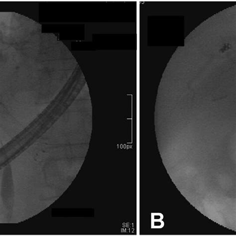 Fluoroscopic Image Of A 57 Year Old Man A Proximal Common Bile Duct