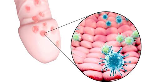 Баланит причины симптомы и лечение у мужчин