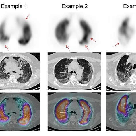 Examples Of Negative P Spect Ct Scans With Perfusion Defects Matched Download Scientific