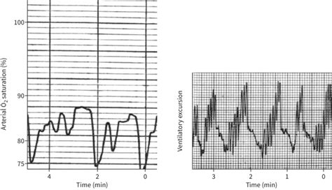 Example Of Nocturnal Oxygen Desaturation With Evidence Of