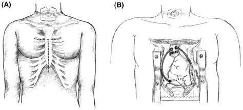 A Semi Circle Skin Incision At The Second Intercostal Space And