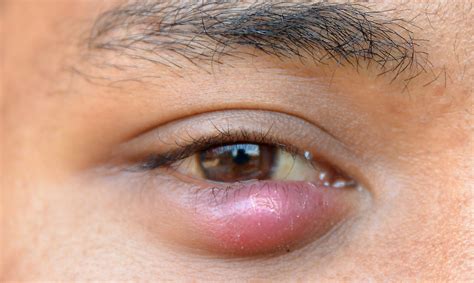 Stye Symptoms Treatment And Prevention Stye Nhs