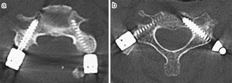 Figure1minimally Invasive Cervical Pedicle Screw Trajectory Download Scientific Diagram