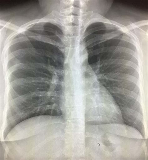 Lung Nodules On Chest X Ray My Xxx Hot Girl