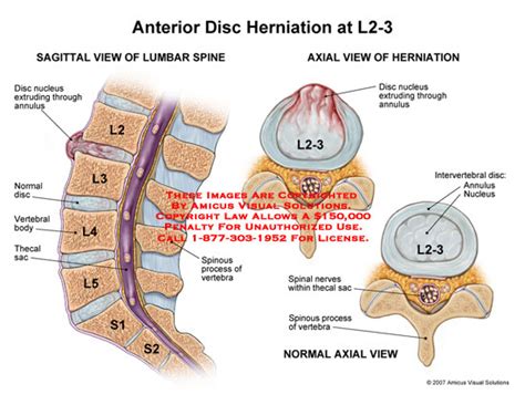 A Herniated Disc What Is A Herniated Disc Extrusion