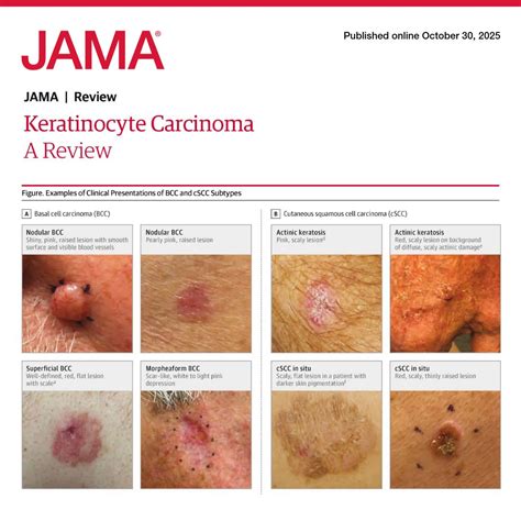 Basal Cell And Squamous Cell Carcinoma A Review Of Epidemiology