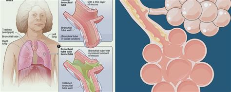 Bronchitis All You Need To Know About It