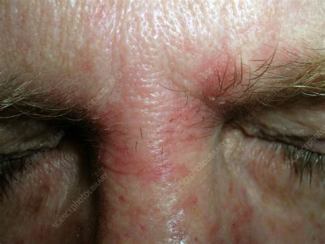 Seborrheic Dermatitis Stock Image C0565163 Science Photo Library