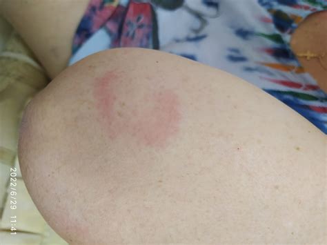 От чего на теле появляются красные пятна и чешутся фото