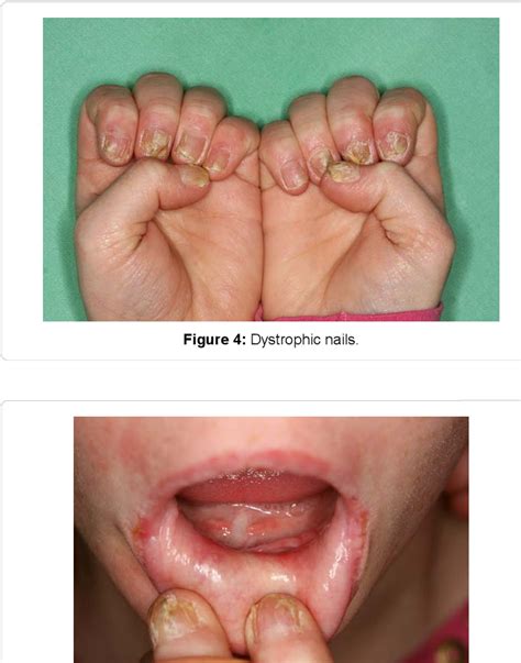 Hypohidrotic Ectodermal Dysplasia Nails