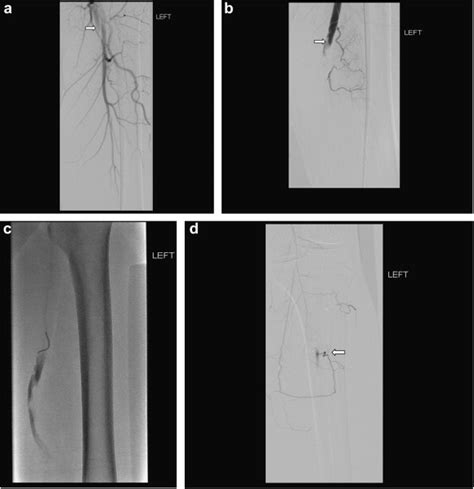 What Is Occlusion Of Sfa At John Jessep Blog
