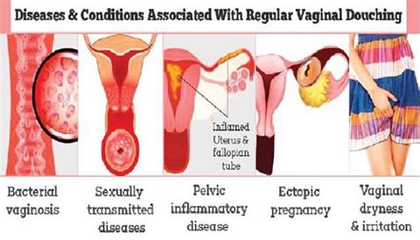 Douching Impacts Negatively On Vagina Acidity Creates Environment For Stis Other Diseases