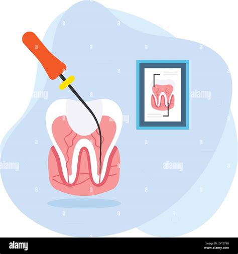 Endodontic Therapy Root Canal Treatment Concept Dental Examination With Probe And Repair