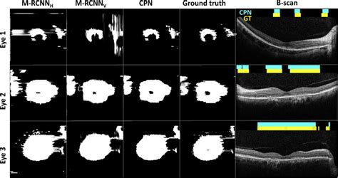 En Face Ellipsoid Zone Loss Maps Generated From Different Models Download Scientific Diagram