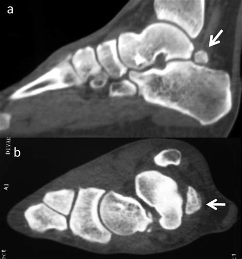 A Large Bone Fragment Posterior To Talus Following Medial Subtalar Dislocation Bmj Case Reports