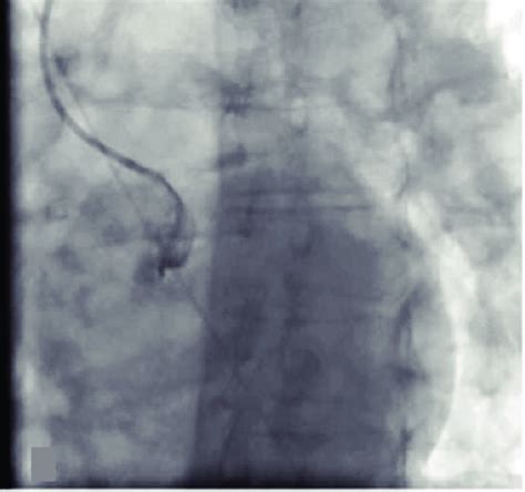 Subtotal Occlusion Of The Left Main Coronary Artery Download Scientific Diagram