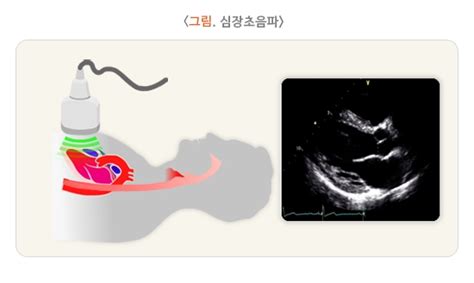 급성호흡곤란증후군 국가건강정보포털 질병관리청