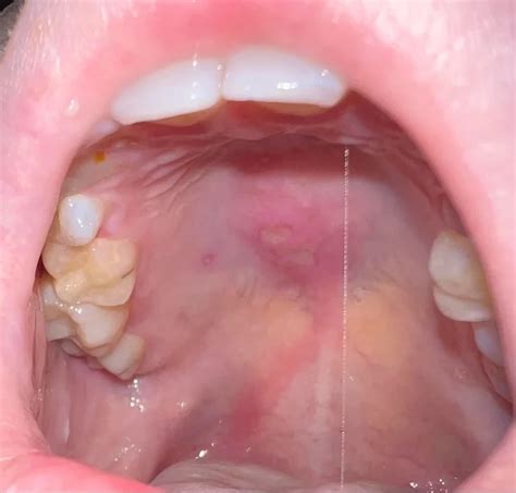 Canker Sore On Roof Of Mouth Mystery Solved The Story On Canker Sores