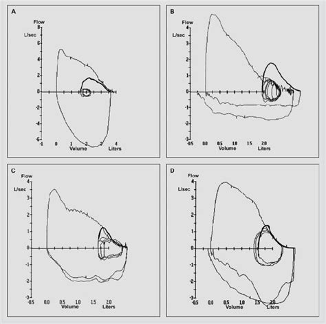 Flow Volume Loop Diagram Spirometry Pulmonary Respiratory Fu