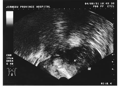 病例6 8 子宫肌瘤8 超声读片