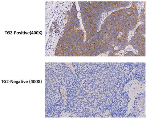 Prognostic Value Of Transglutaminase 2 In Non Small Cell Lung Cancer