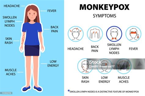 원숭이 두 바이러스 증상 여성과 인포 그래픽 두통 허리 통증 림프절 부종 발열 피부 발진 등 두통 허리 통증 등 유럽과 미국에서 새로운 발병 사례 원숭이수두에 대한 스톡