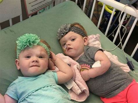 A Year After Their Separation Conjoined Twins Celebrate Their New Lives
