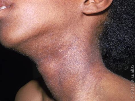 Psoriasis Vs Eczema On Black Skin What Are The Differences Goodrx