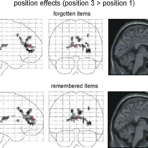 Position Effects In The Anterior Cingulate Cortex For Both Download Scientific Diagram