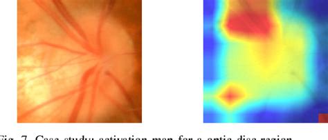 Figure 1 From Glaucoma Grading Using Multimodal Imaging And Multilevel Cnn Semantic Scholar