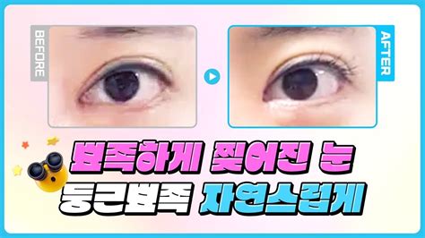 뾰족하게 찢어진 눈 청순하게 바뀐 후기 메이트성형외과 Youtube