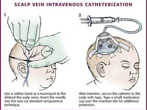 Iv Therapy In Neonate Medizzy