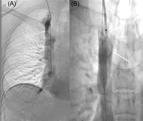 A Venogram Via A Right Internal Jugular Vein 8f Again Shows The