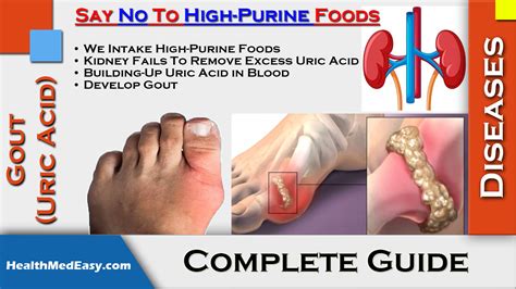 Gout And Uric Acid Symptoms Treatments Side Effects Healthmedeasy
