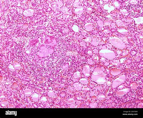Subacute Granulomatous Thyroiditis Light Micrograph Of A Section