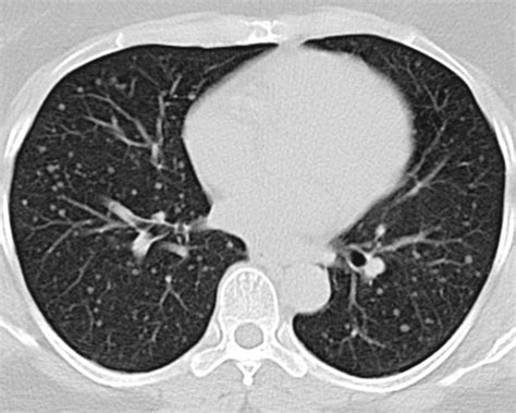 Miliary Metastases Radrounds Radiology Network