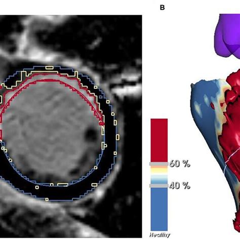 Myocardial Scar Characterization In A Short Axis Slice Of Lge Cmr A Download Scientific