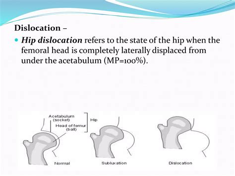 Hip Dislocation Ppsx