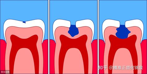 牙齿“火气大”导致牙疼？原因其实还有这些！ 知乎