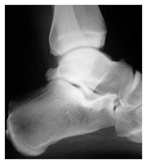 Lateral X Ray Prominent Posterior Talar Process Download Scientific Diagram