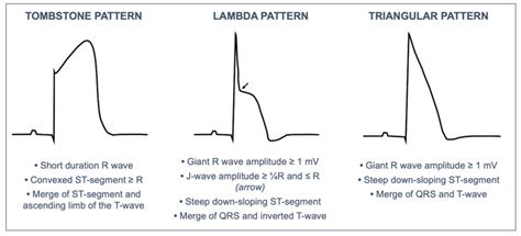 Electrocardiographic Predictors Of Primary Ventricular Fibrillation And