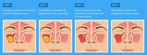 Sinus Infection Chicago Balloon Sinuplasty Chicago Chicago Ent