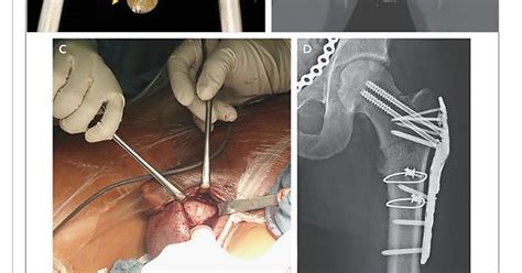 Femoral Head Dislocation Imgur