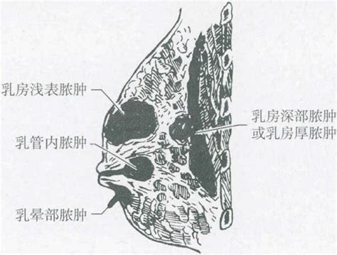 第四节 急性乳腺炎 超声引导麦默通