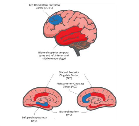 A Deluded Brain General Alterations Of Brain Activity In Delusional