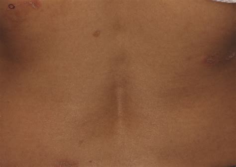 Erythema Annulare Centrifugum School Of Medicine