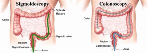 What Is A Sigmoidoscopy Oakville North Endoscopy
