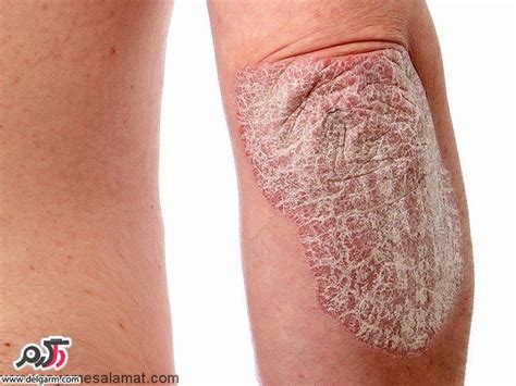 علت پسوریازیس صدفک بیماری پوستی مزمن