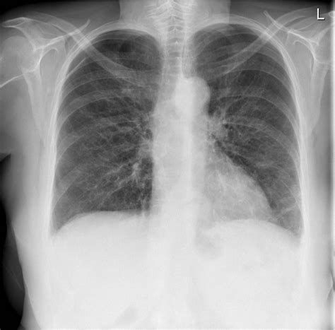 Interstitial Pneumonia