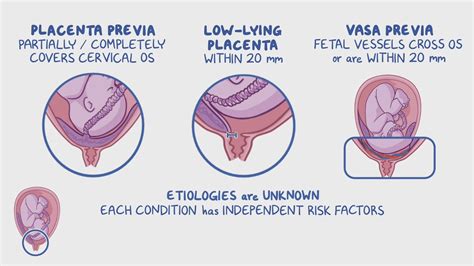 Placenta Previa And Vasa Previa Clinical Sciences Osmosis Video Library